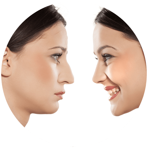 Burun (Rinoplasti) Estetiği